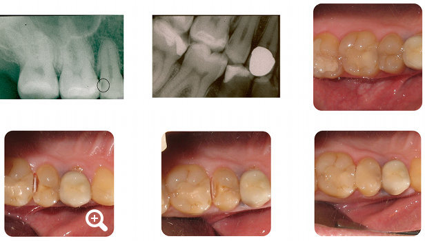 Diagnosis and Conservative Therapy for Interproximal Decay | David Vine ...