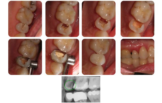 Fractured Tooth Restoration | David Vine D.D.S.
